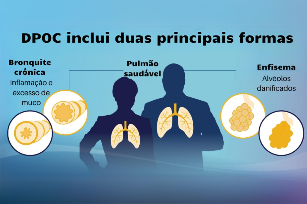 DPOC: Como a Fisioterapia Respiratória ajuda na sua respiração